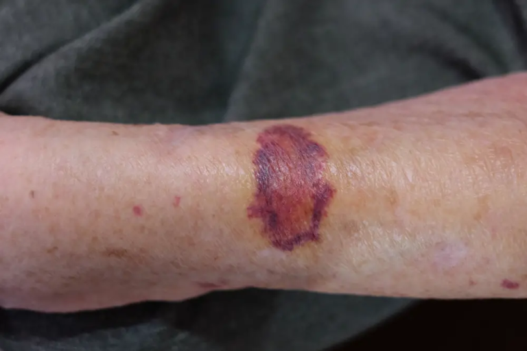 8 Reasons Why You’re Bruising Easily