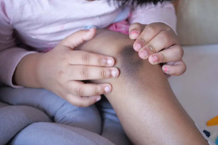 8 Reasons Why You’re Bruising Easily