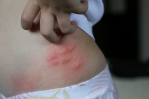 25 Painful Stings and Bites You Don’t Want to Experience in Your ...