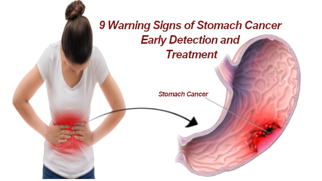 9 Early Warning Signs of Stomach Cancer You Shouldn’t Ignore